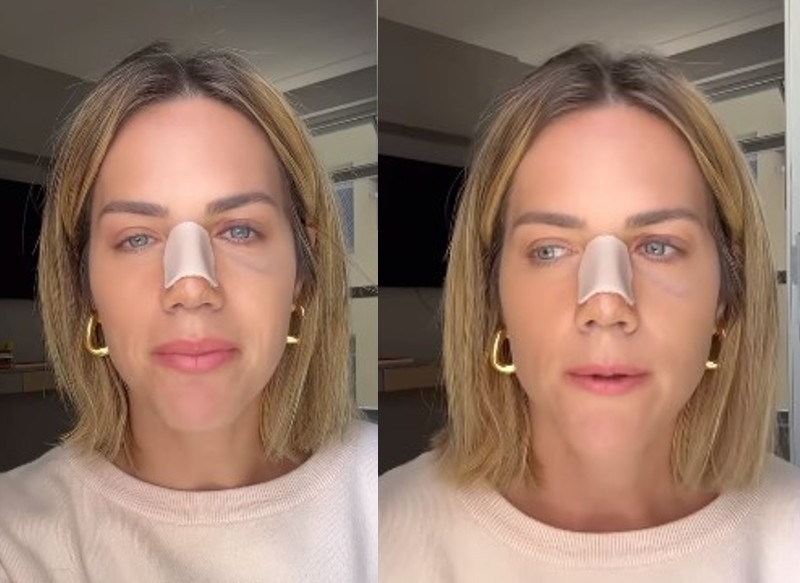 Entenda mais sobre a cirurgia de desvio de septo, realizada pela atriz ...